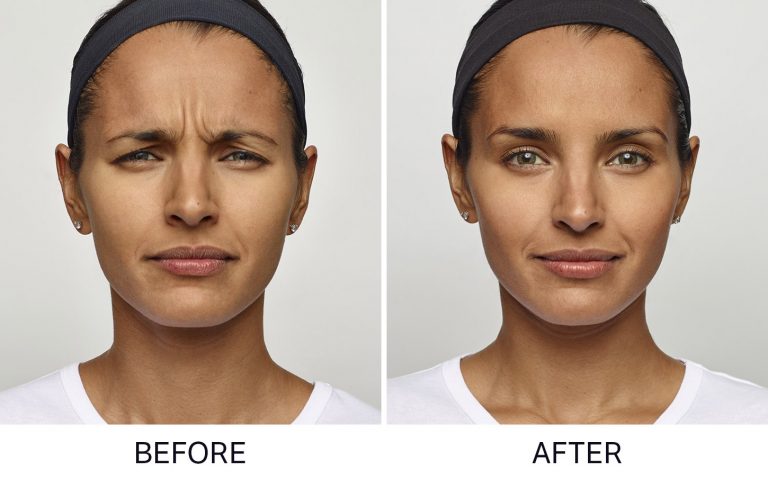 Dysport Injections in Boston | Boston Plastic Surgery