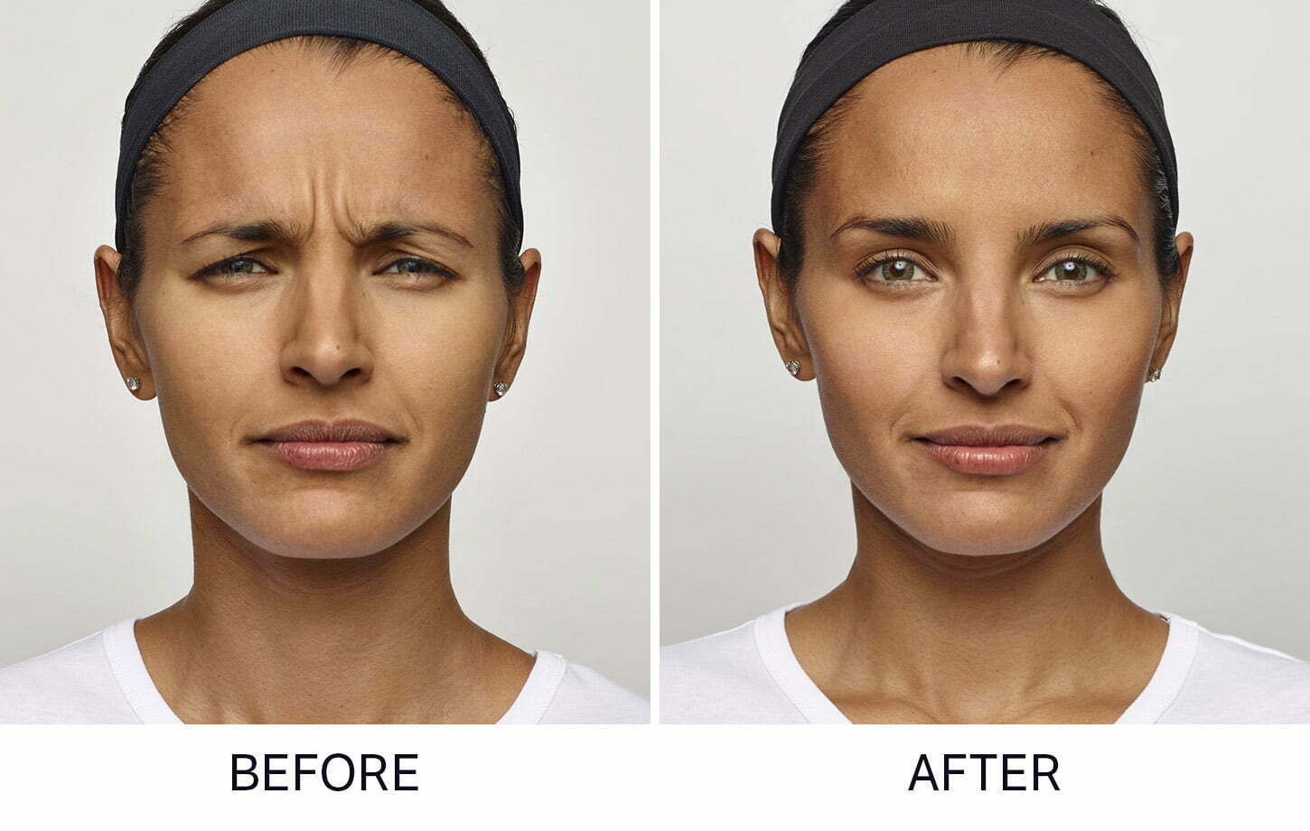 Dysport Injections in Boston | Boston Plastic Surgery