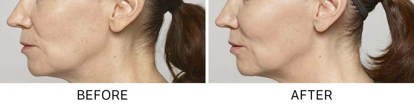 Restylane Lyft - Boston Plastic Surgery