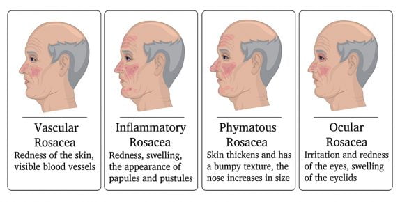 5 Things to Know About Rosacea in Honor of Rosacea Awareness Month ...