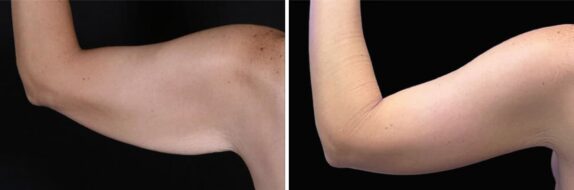 Upper Arm Lift - Boston Plastic Surgery