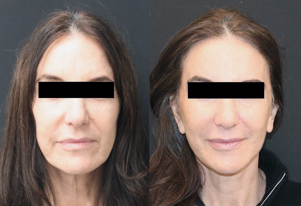 Facelift Boston | Facelift Surgery (Rhytidectomy) with Boston Plastic ...