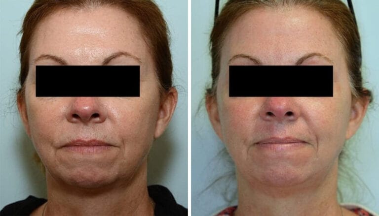 Specials - Boston Plastic Surgery